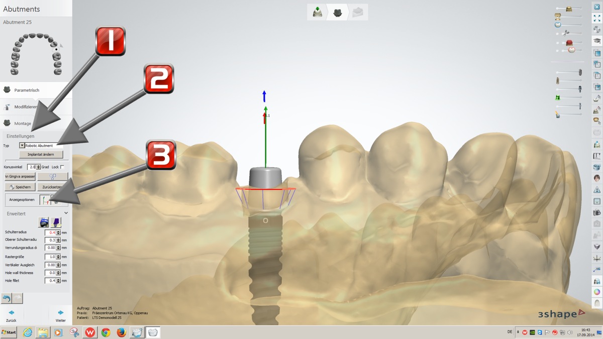 3shape - Abutment – a4lwiki